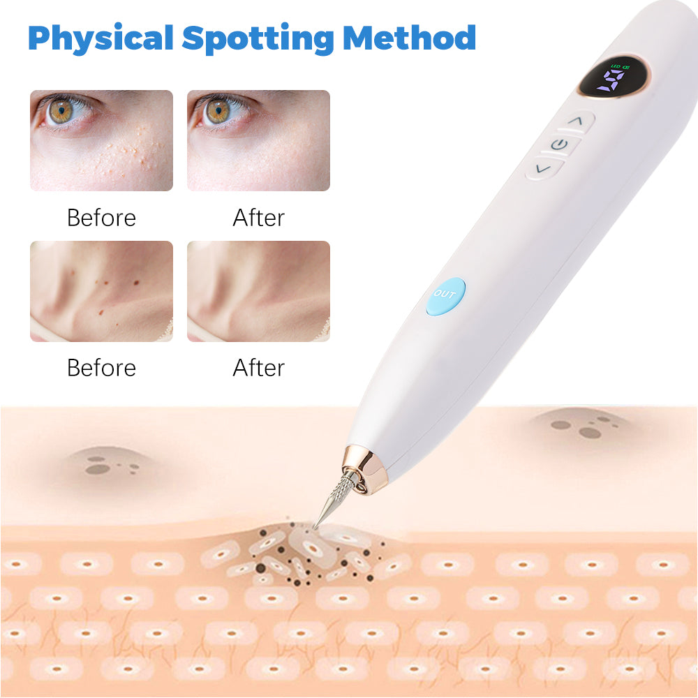 Special Offer Laser Skin Tag Face Mole Pen Freckle Black Spot Removal ...